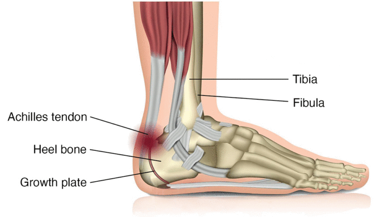 Sever’s Disease – Calcaneal Apophysitis › The Foot Clinics - Wagga ...